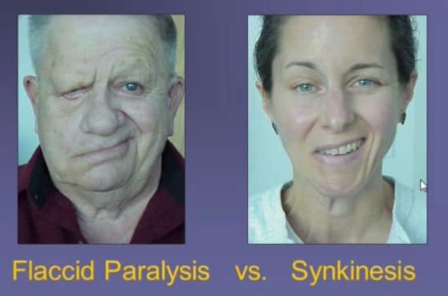 סינקינזיס (Synkinesis) - פציאליס, בלס פלסי ושיתוק פנים